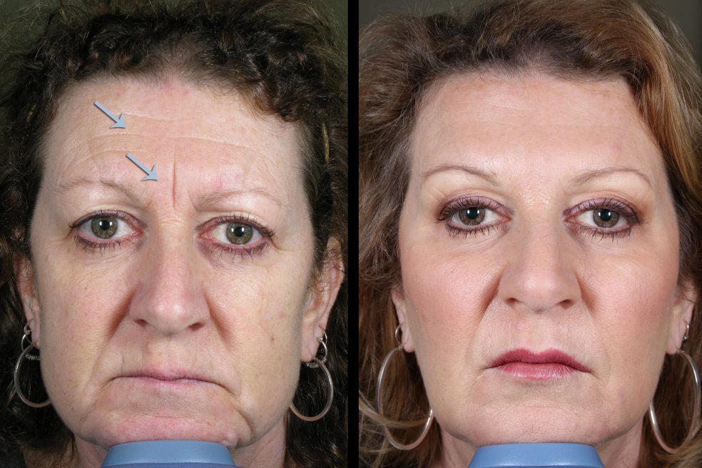 Treatment Gallery - MD ESTHETICS