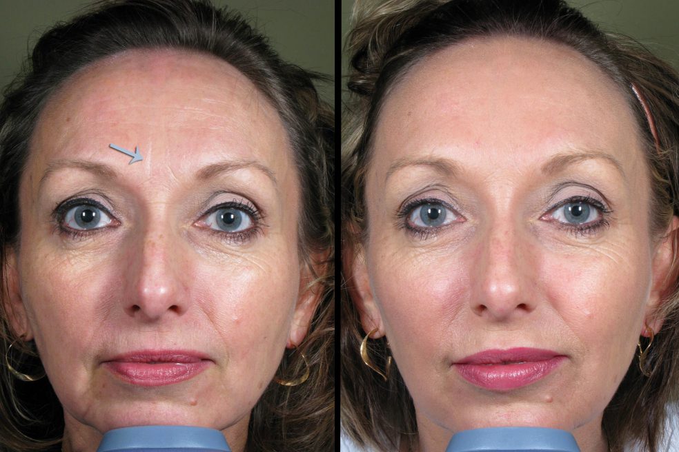 Treatment Gallery - MD ESTHETICS