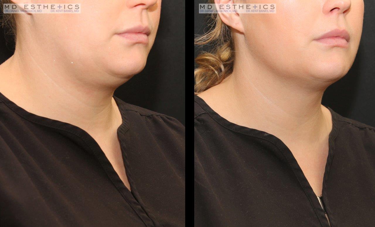 Check Out My CoolSculpting Results! - MD ESTHETICS