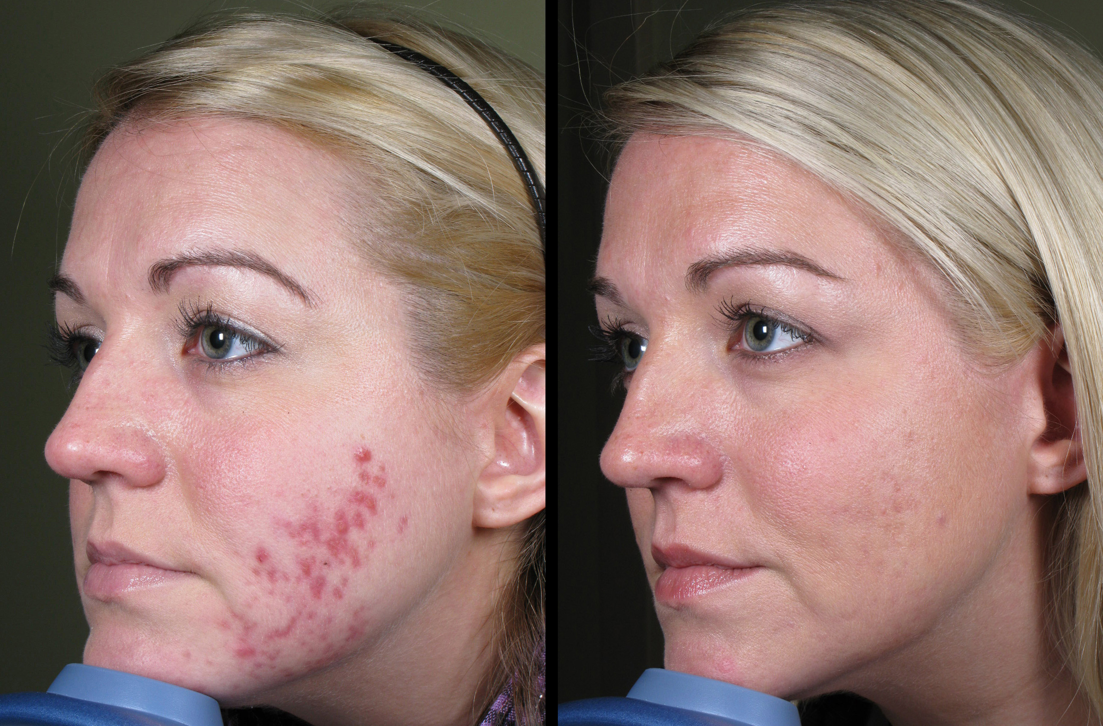 Laser for facial redness 3 - MD ESTHETICS