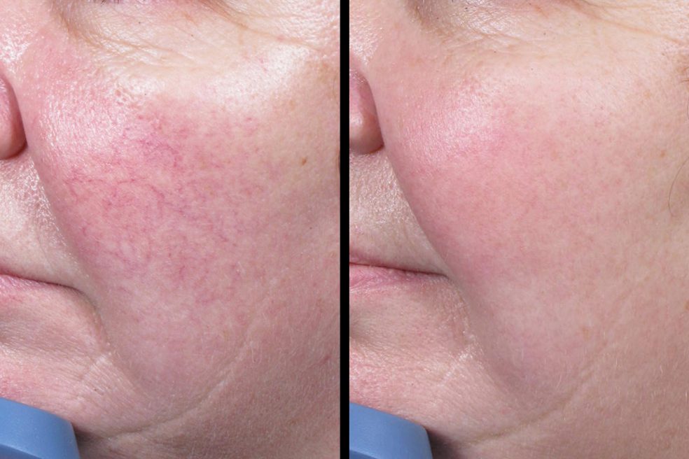 Treatment Gallery - MD ESTHETICS