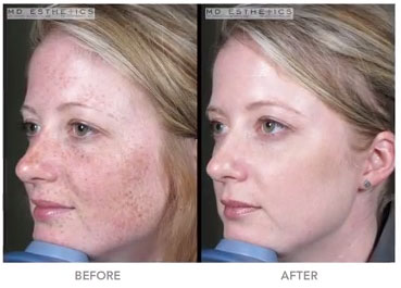 Options for Brown Spots and Pigmentation Challenges - MD ESTHETICS